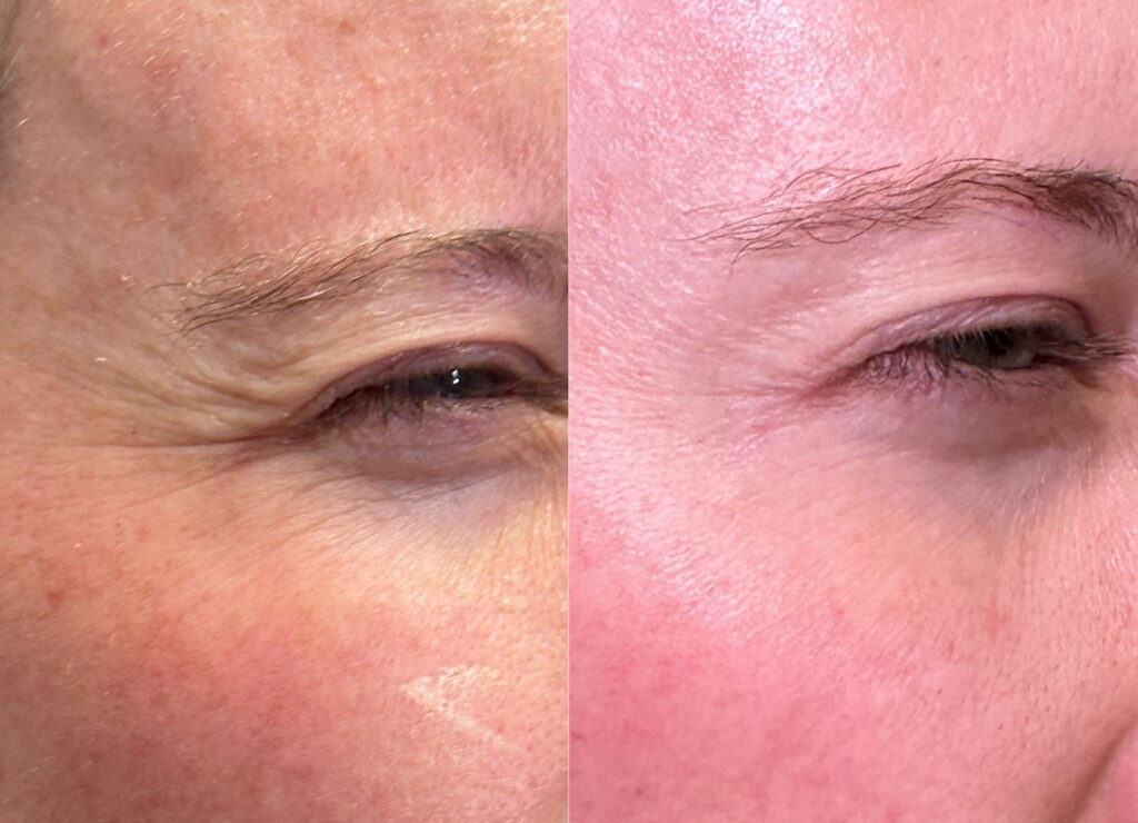 Botox Centennial | Lash and Company Med Spa Centennial